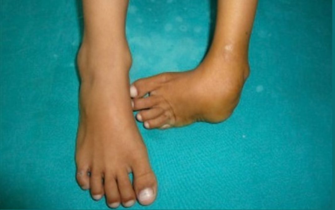 Everything about upper and lower limb reduction defects