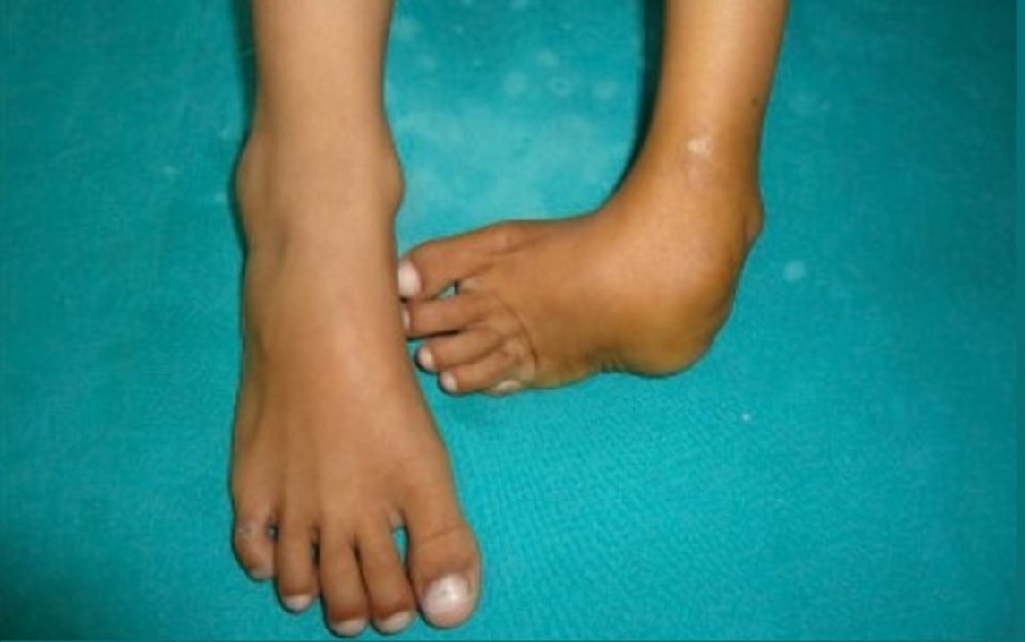 Everything about upper and lower limb reduction defects